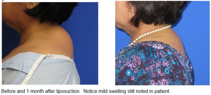 Treating Dorsal-Cervical Fat or the Buffalo Hump | Aesthetic Laser Center
